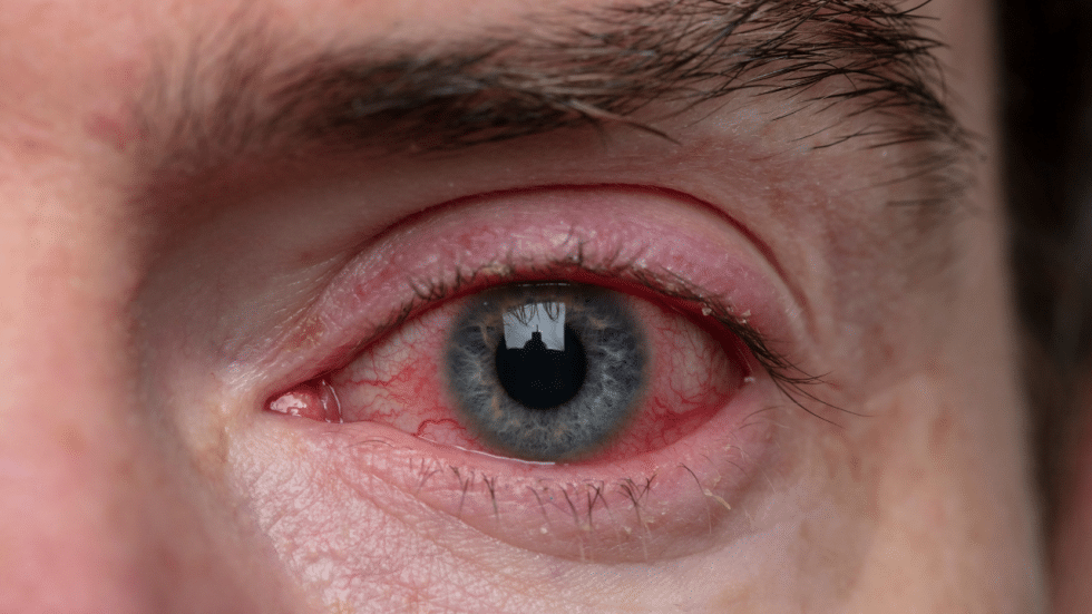 Vision Warnings: Top 10 Eye Infections and Their Tell-Tale Symptoms ...