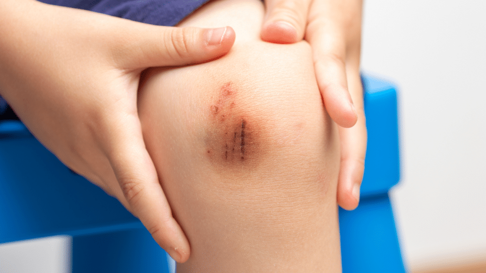 How Can Scrapes Lead to Serious Health Issues Beyond Simple Wounds ...