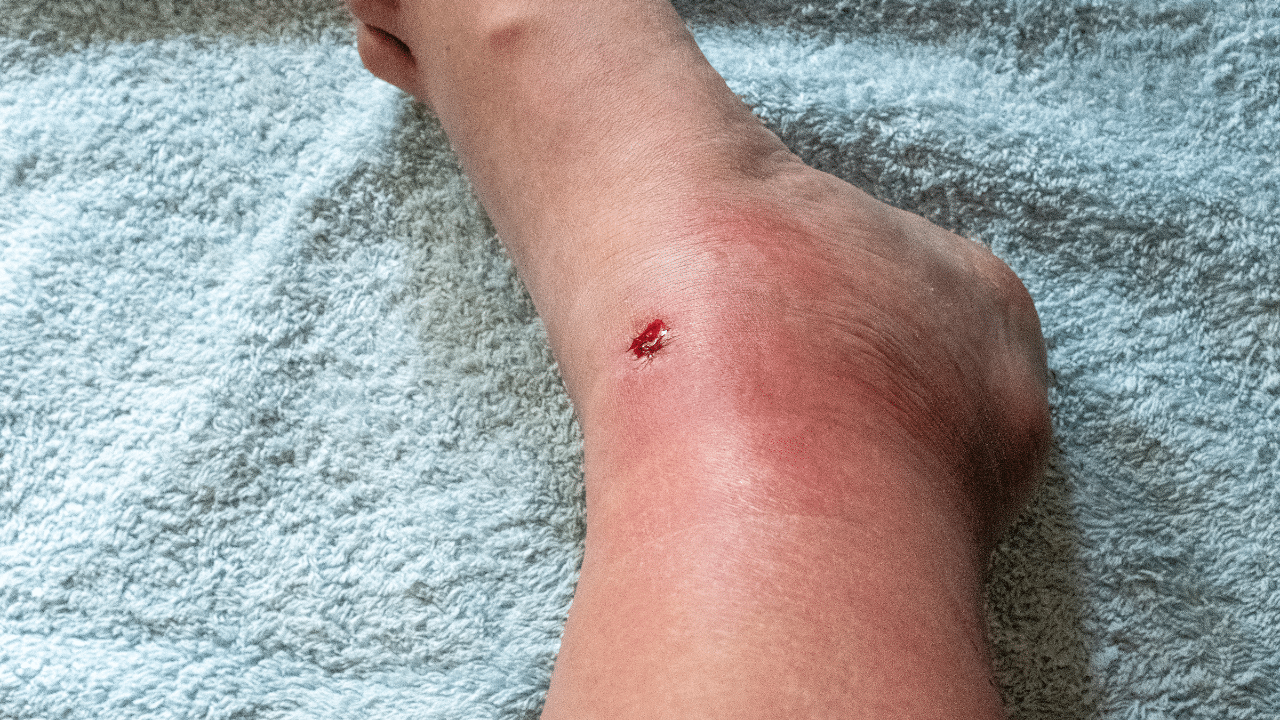 Can a Puncture Wound Cause Systemic Infection? Recognizing the Red ...