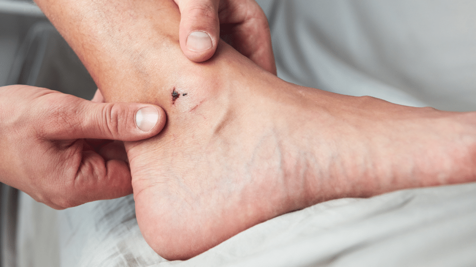 How Can You Assess the Severity of a Deep Puncture Wound? - First ...