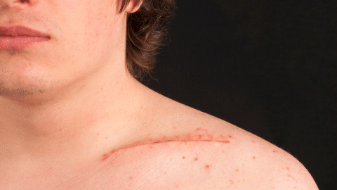 How to Relieve Pain From Wound Stitches? - First Choice Immediate Care