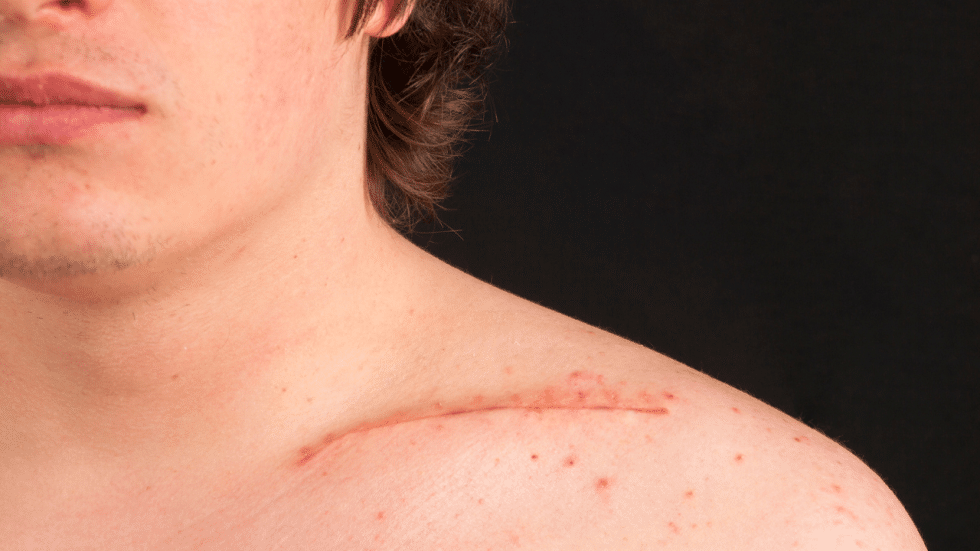 How to Relieve Pain From Wound Stitches? - First Choice Immediate Care