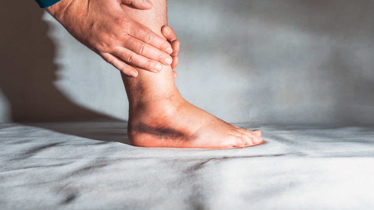What Are the Essential Steps for Effective Sprain Recovery? - First ...