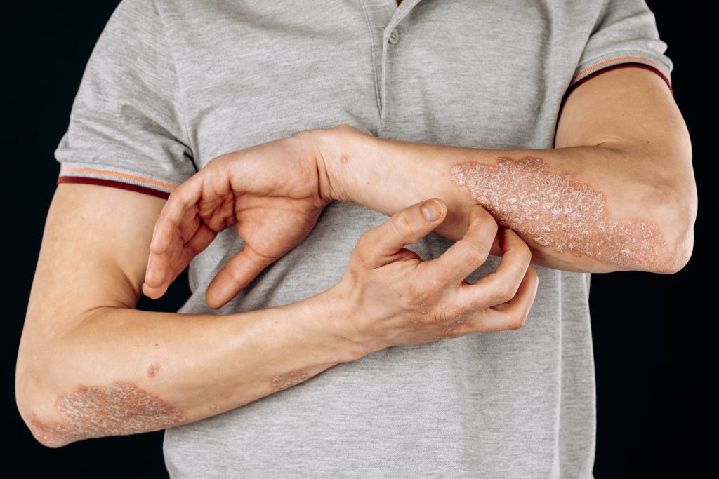 Does Alcohol Kill Ringworm on Surfaces in Chicago?