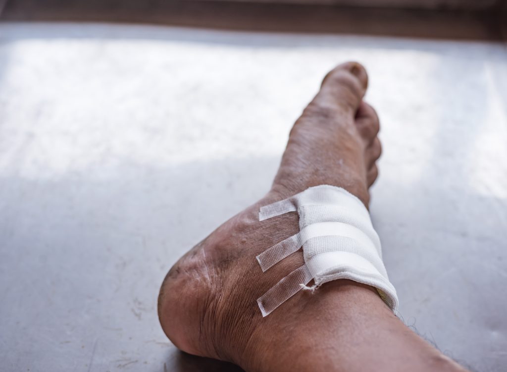 Glass in Foot Infection Symptoms in Naperville